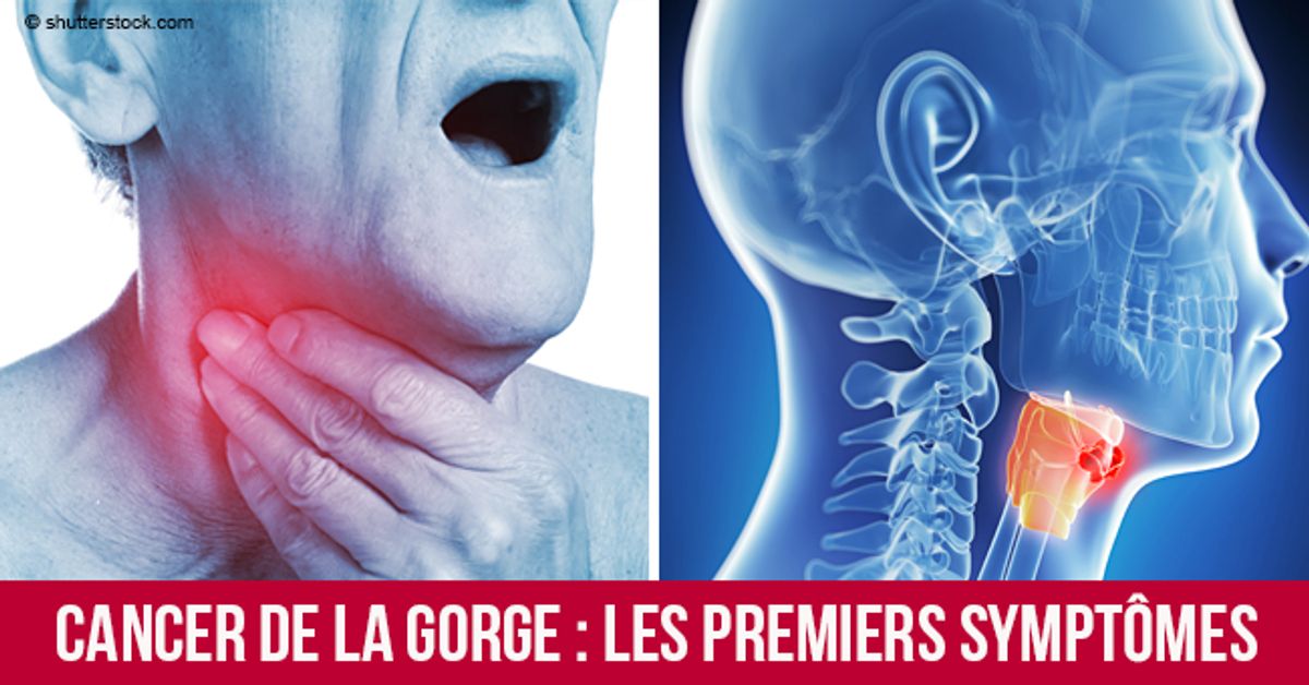 Les sept symptômes d'un cancer de la gorge